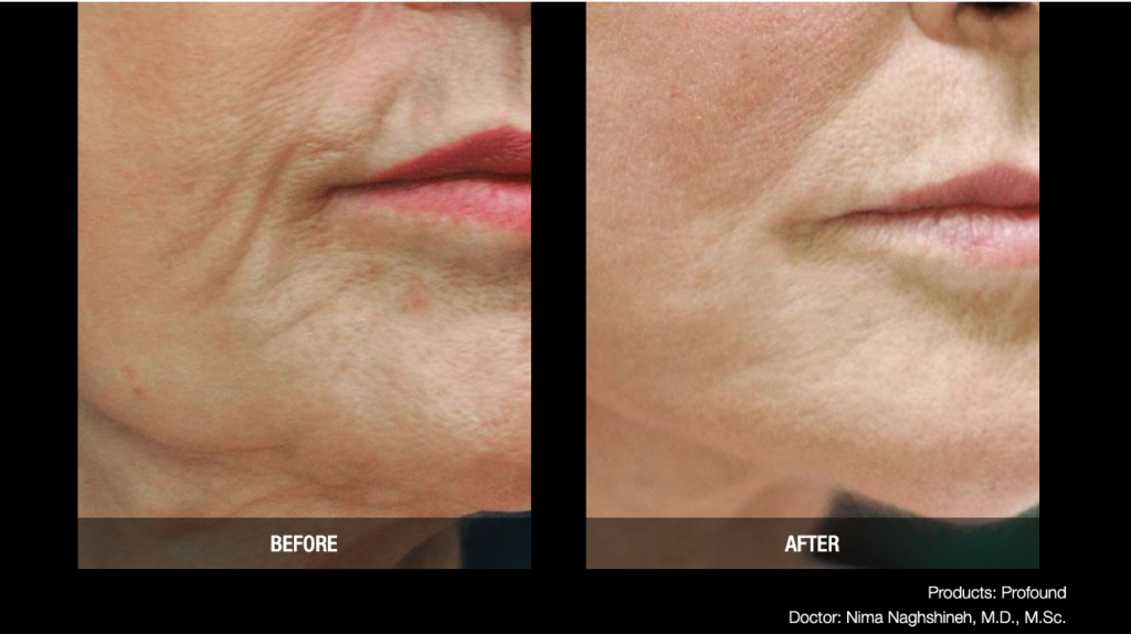 Profound Non-Surgical Face-Lift | FDA Approved Skin Rejuvenation