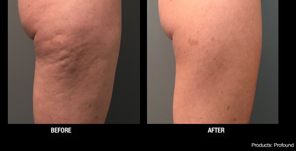 Profound Non-Surgical Face-Lift | FDA Approved Skin Rejuvenation