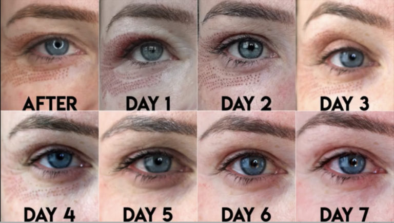 Plexr Plasma Pen | Tone & Tighten Skin With Innovative Technology